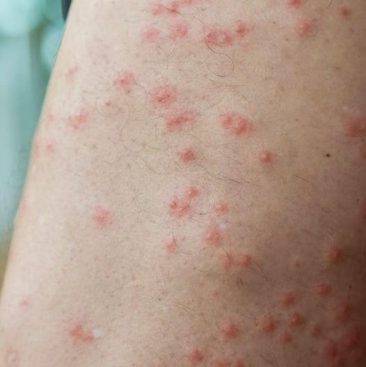 How To Identify 10 Of The Most Common Bug Bites - My Blog