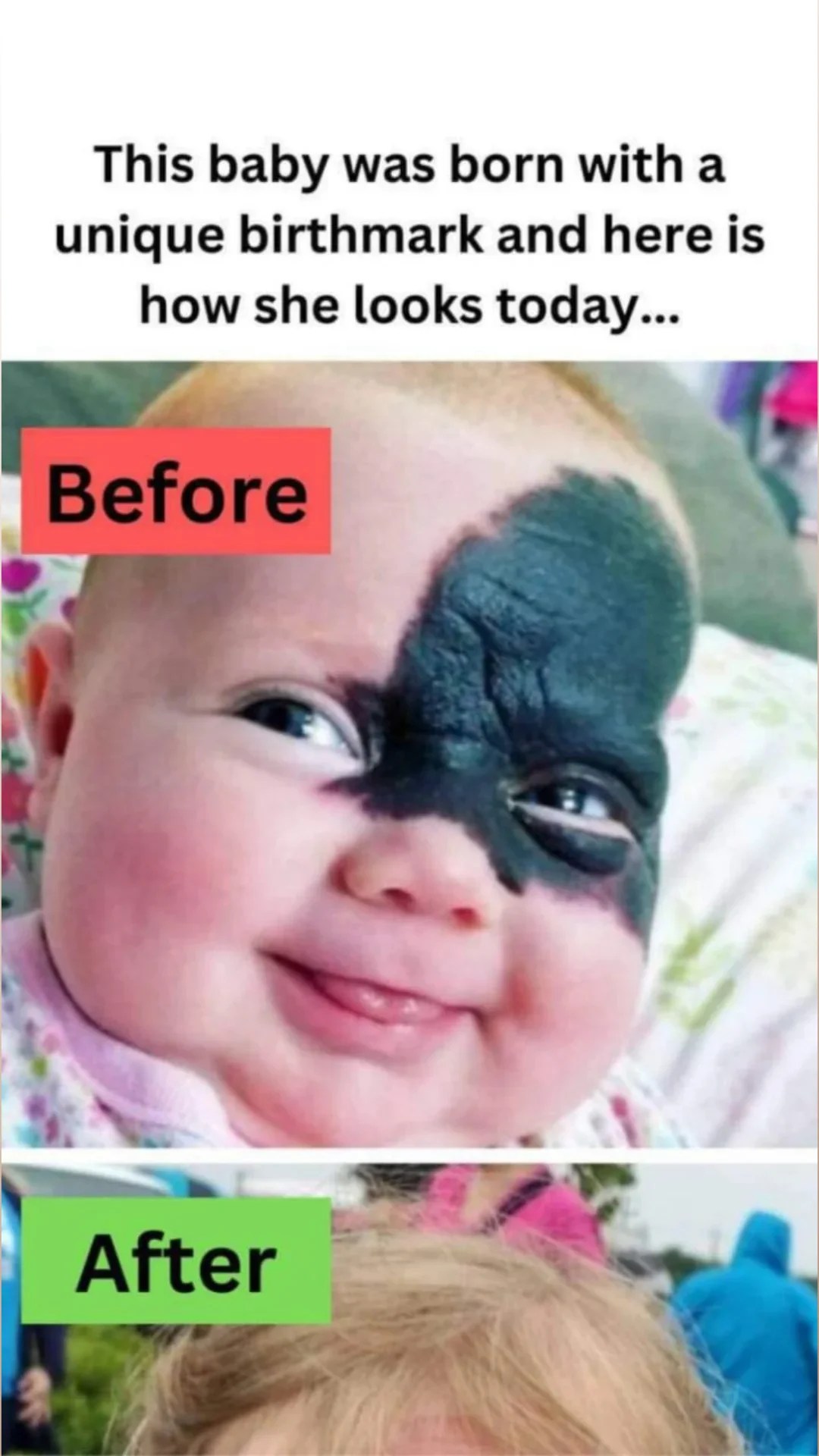 This baby was born with a unique birthmark and here is how she looks ...